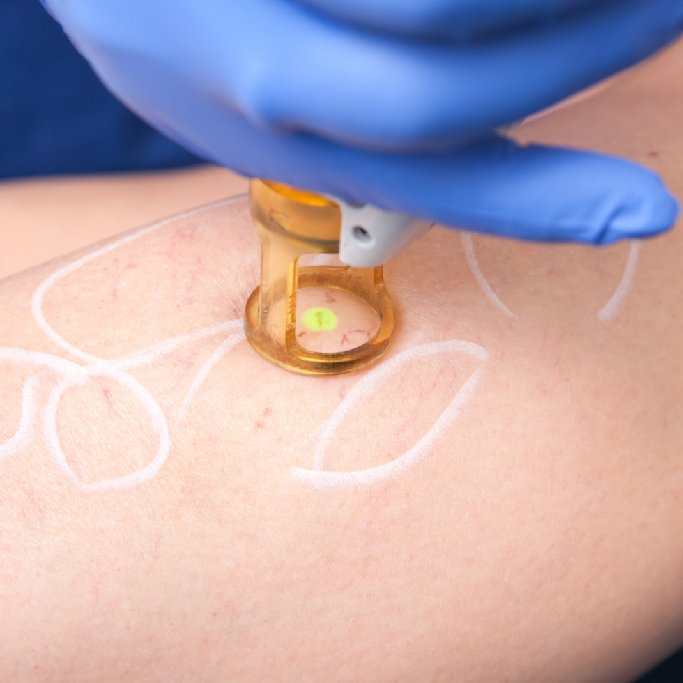 Laser vasculaire - Cabinet Clairefeuille Dermatologie Esthétique